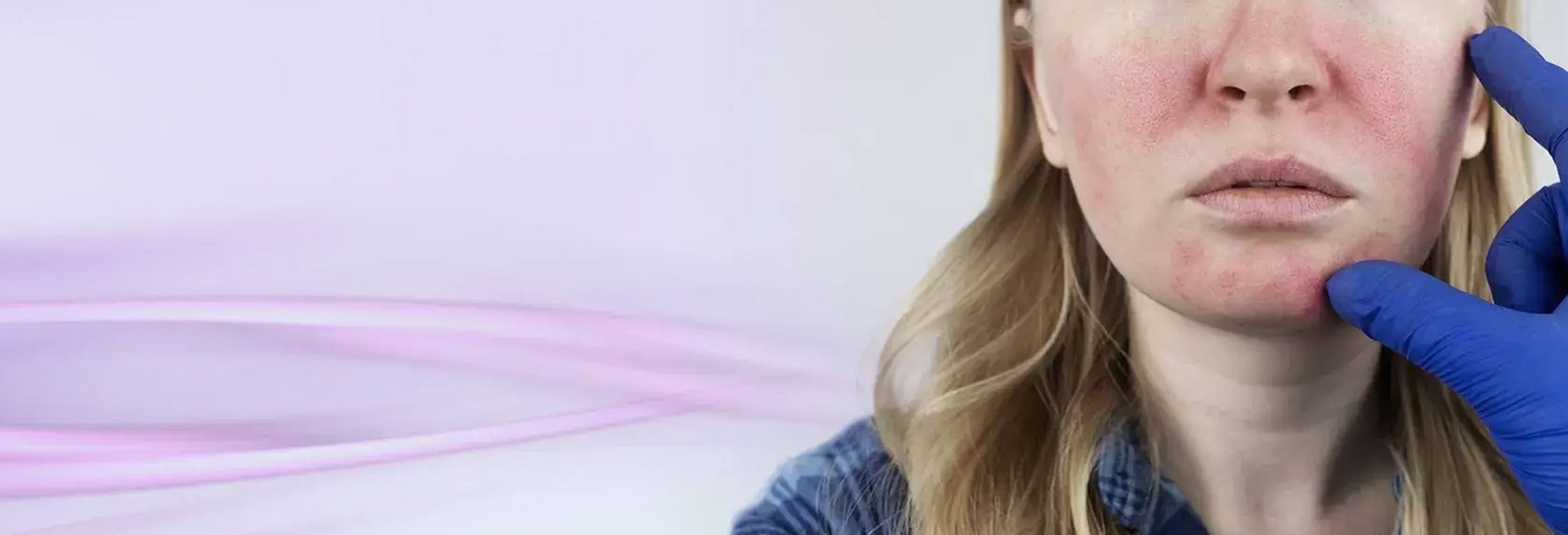 Vascular Lesion Removal in Houston | Chehr Laser & Medical Spa